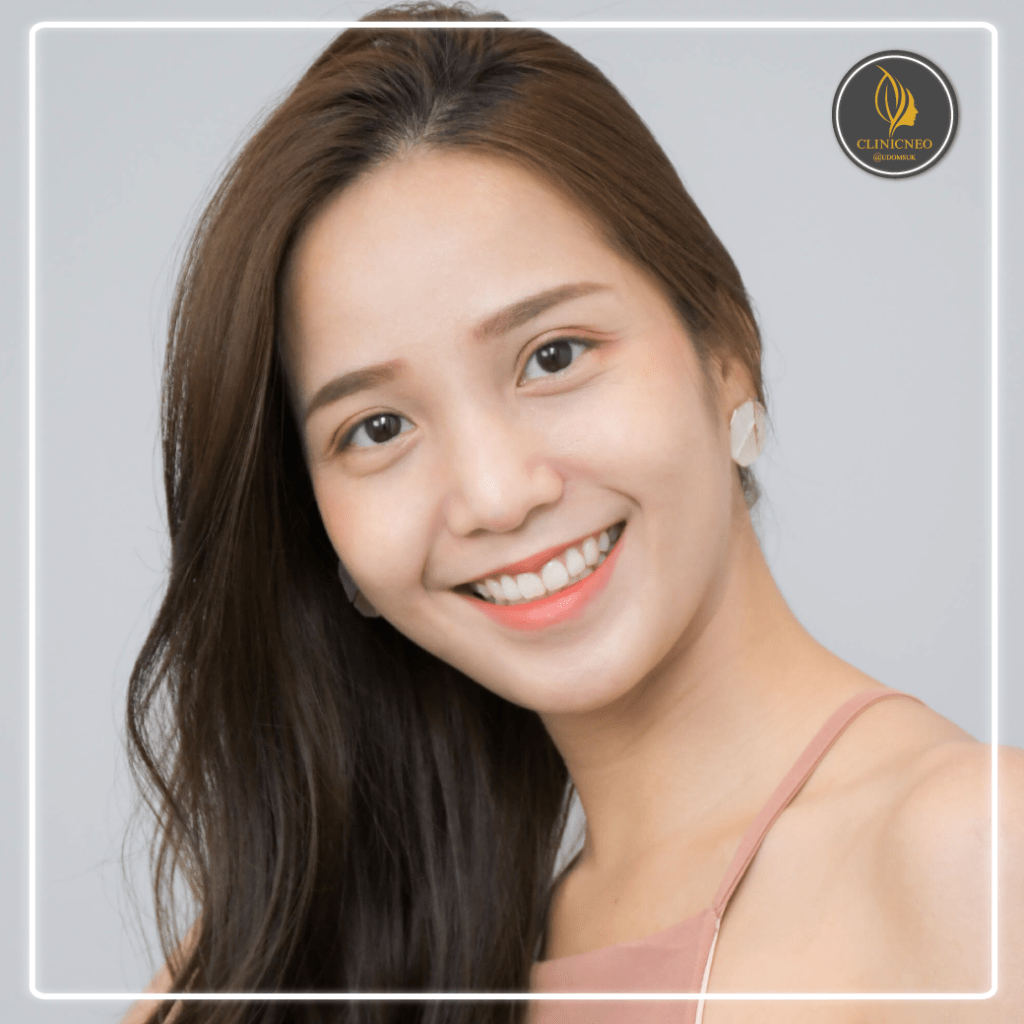 Facial and Body Contouring by mesofat injection , Lipolift threads ...